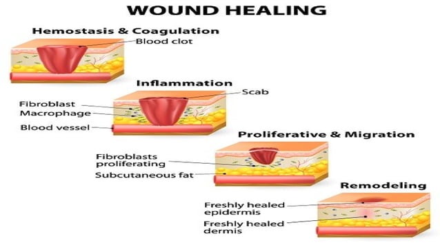 Wound healing Acute wounds : Trauma , surgical wounds ,burn.pptx