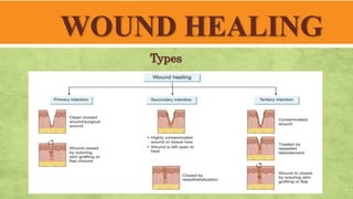 WOUND HEALING- Basic Principles in Surgery.pptx