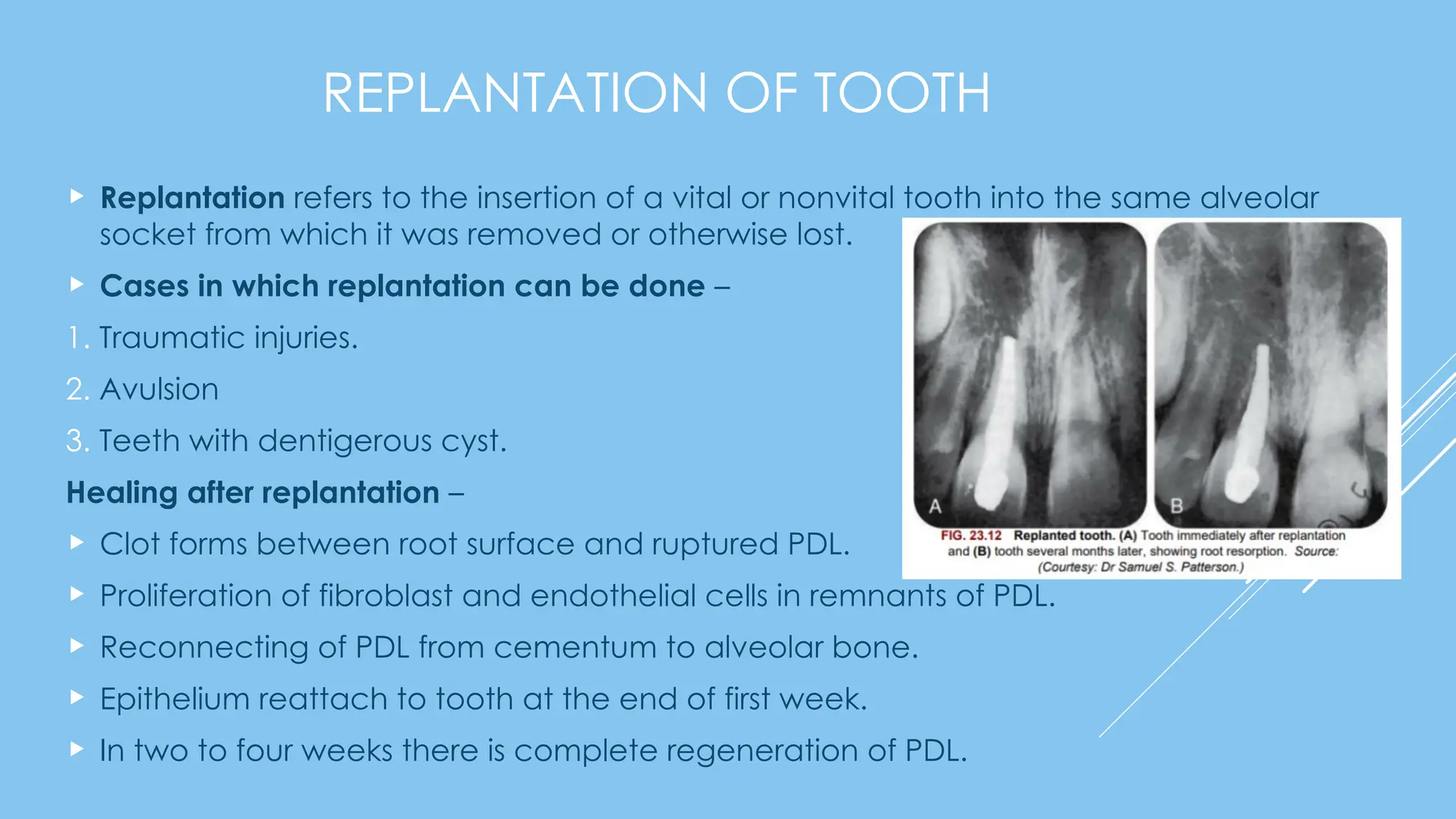 Wound Healing, factors affecting it and its mechanism | PPTX