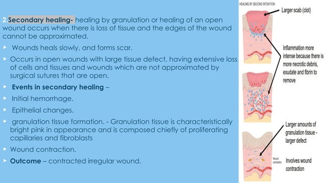 Wound Healing, factors affecting it and its mechanism | PPTX