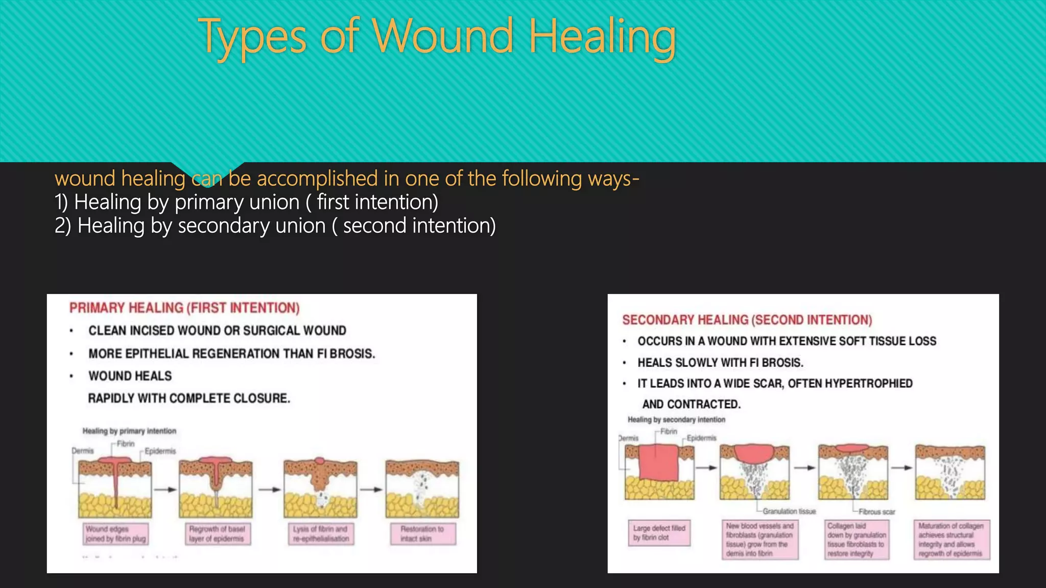 Wound healing and repair | PPTX