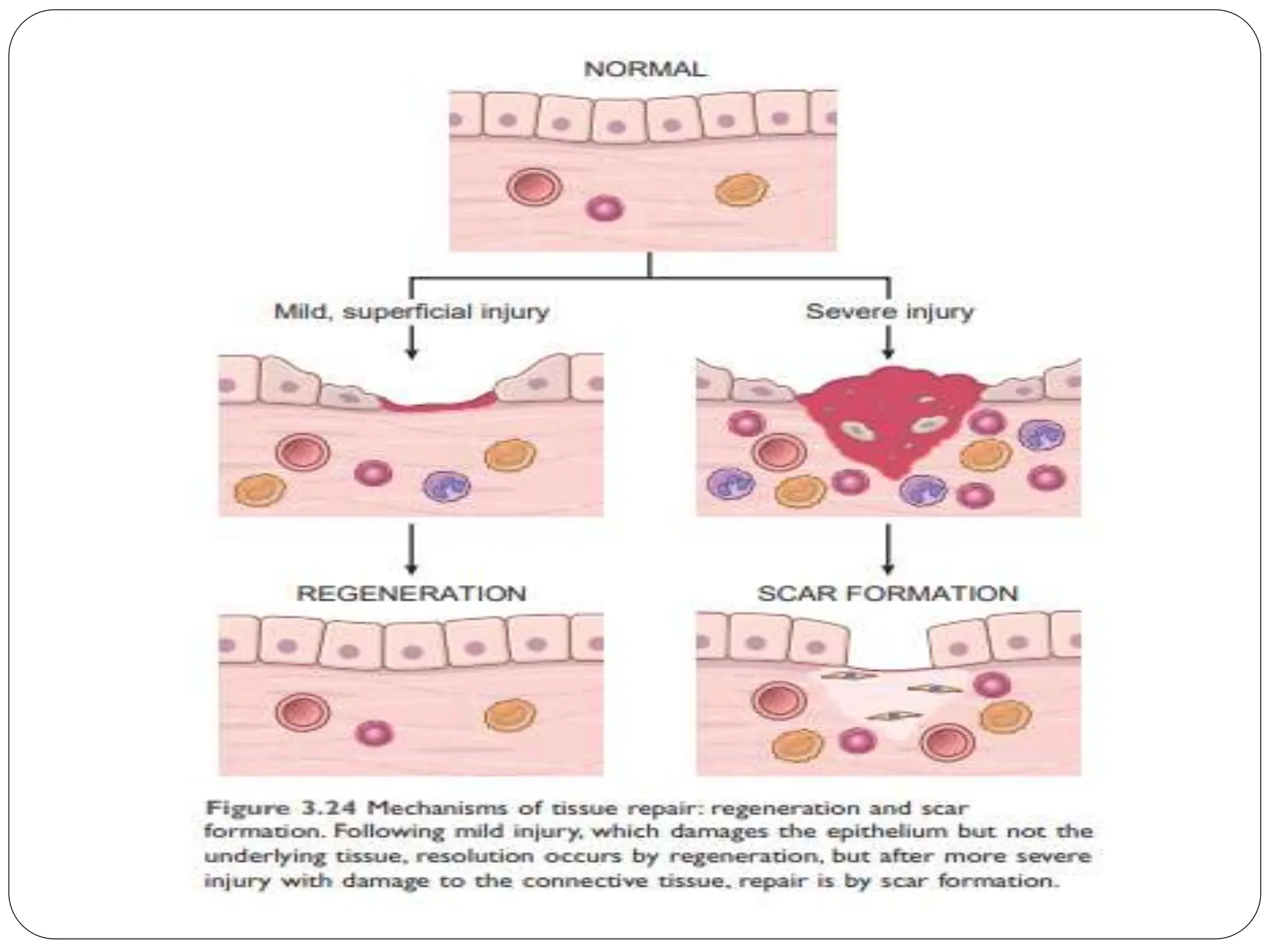 Wound healing and repair Repair/Healing : restoration of tissue ...