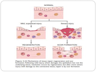 Wound healing and repair Repair/Healing : restoration of tissue ...