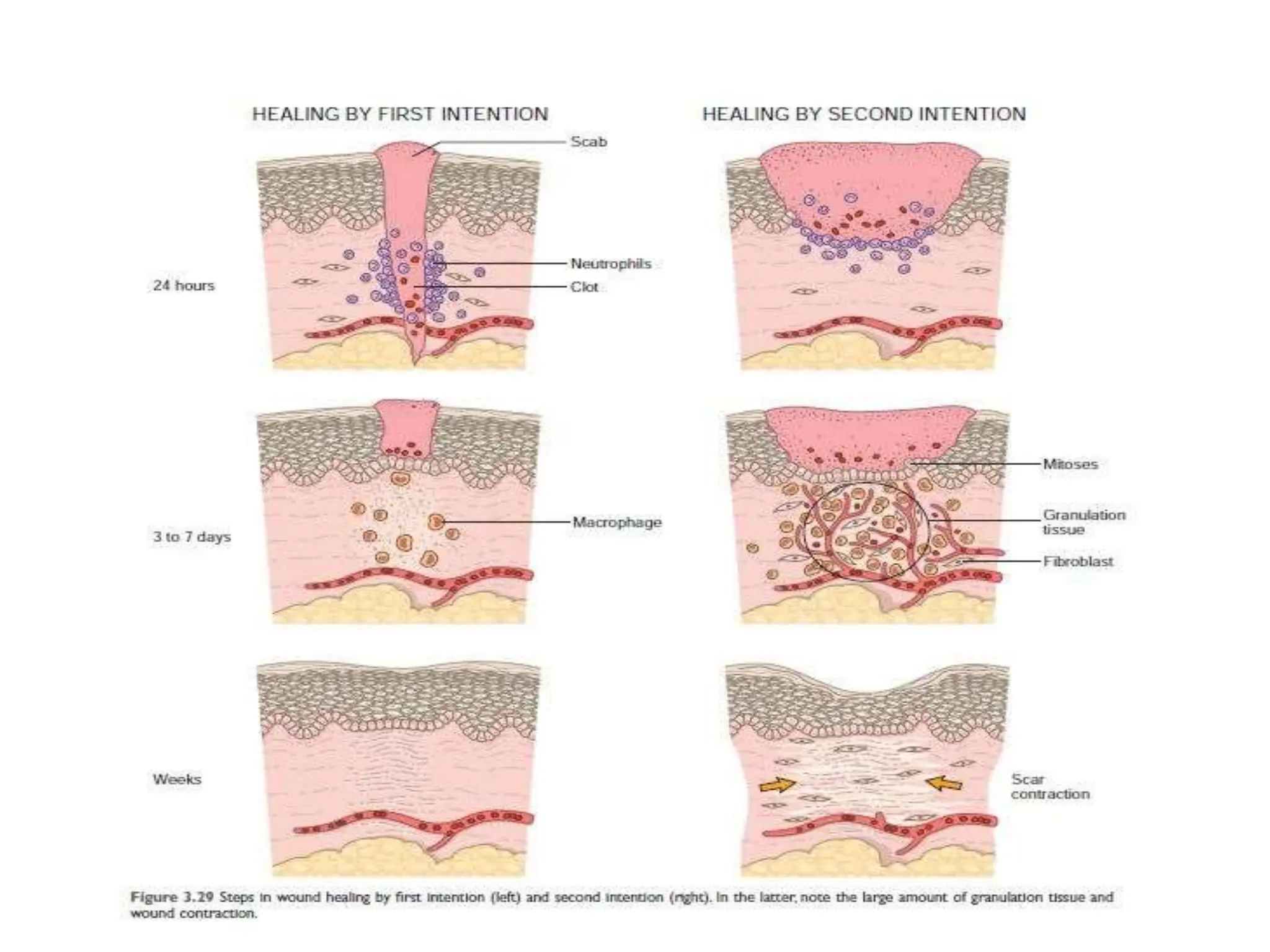 wound healing , factors affectings and wound management | PPTX