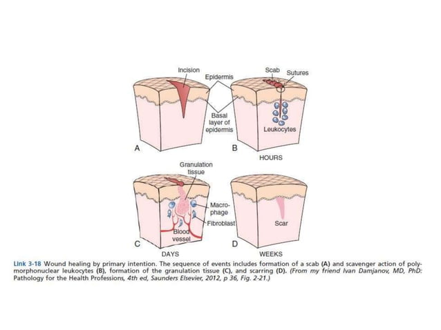 wound healing , factors affectings and wound management | PPTX