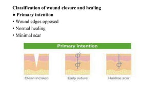 wound healing [Autosaved].pptx
