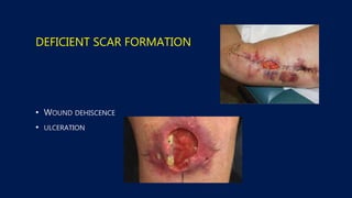 Wound healing (cutaneous) | PPT