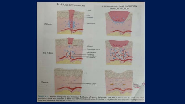 Wound healing (cutaneous) | PPT