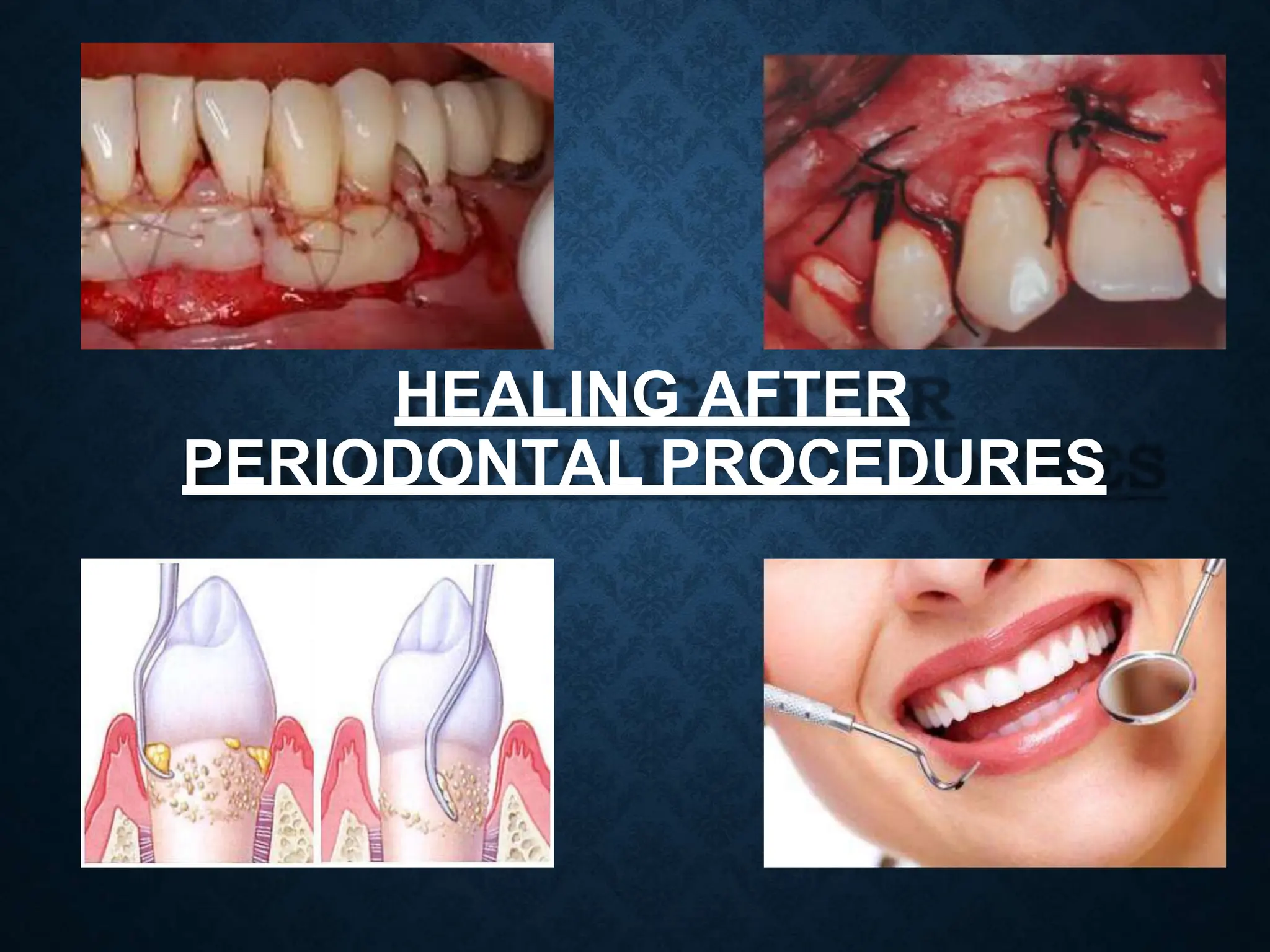Wound Healing in Periodontology .pptx