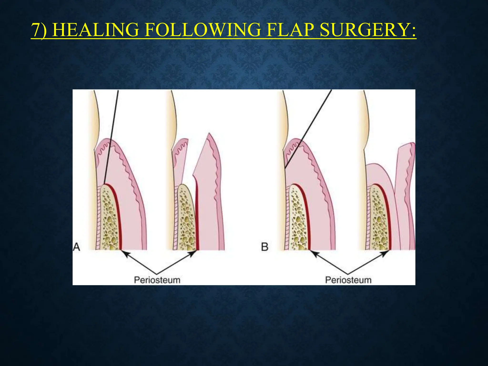 Wound Healing in Periodontology .pptx