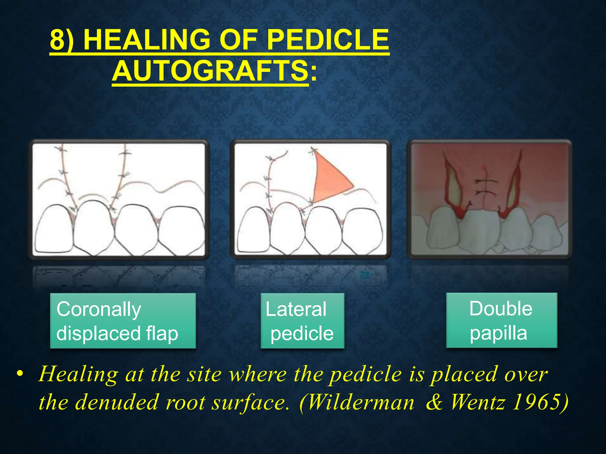 Wound Healing in Periodontology .pptx