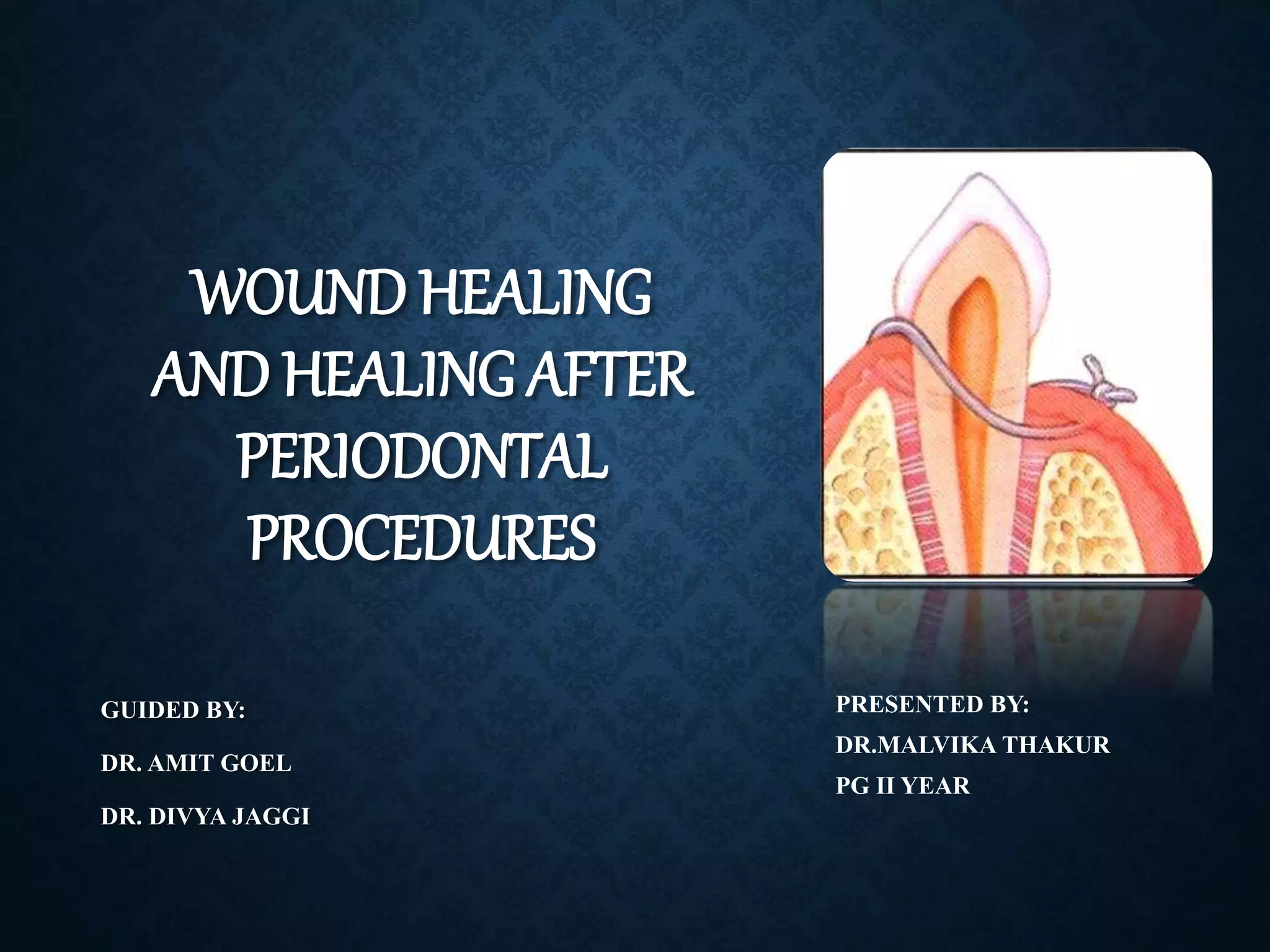 Wound healing in Perio - Dr. Malvika Thakur | PPTX