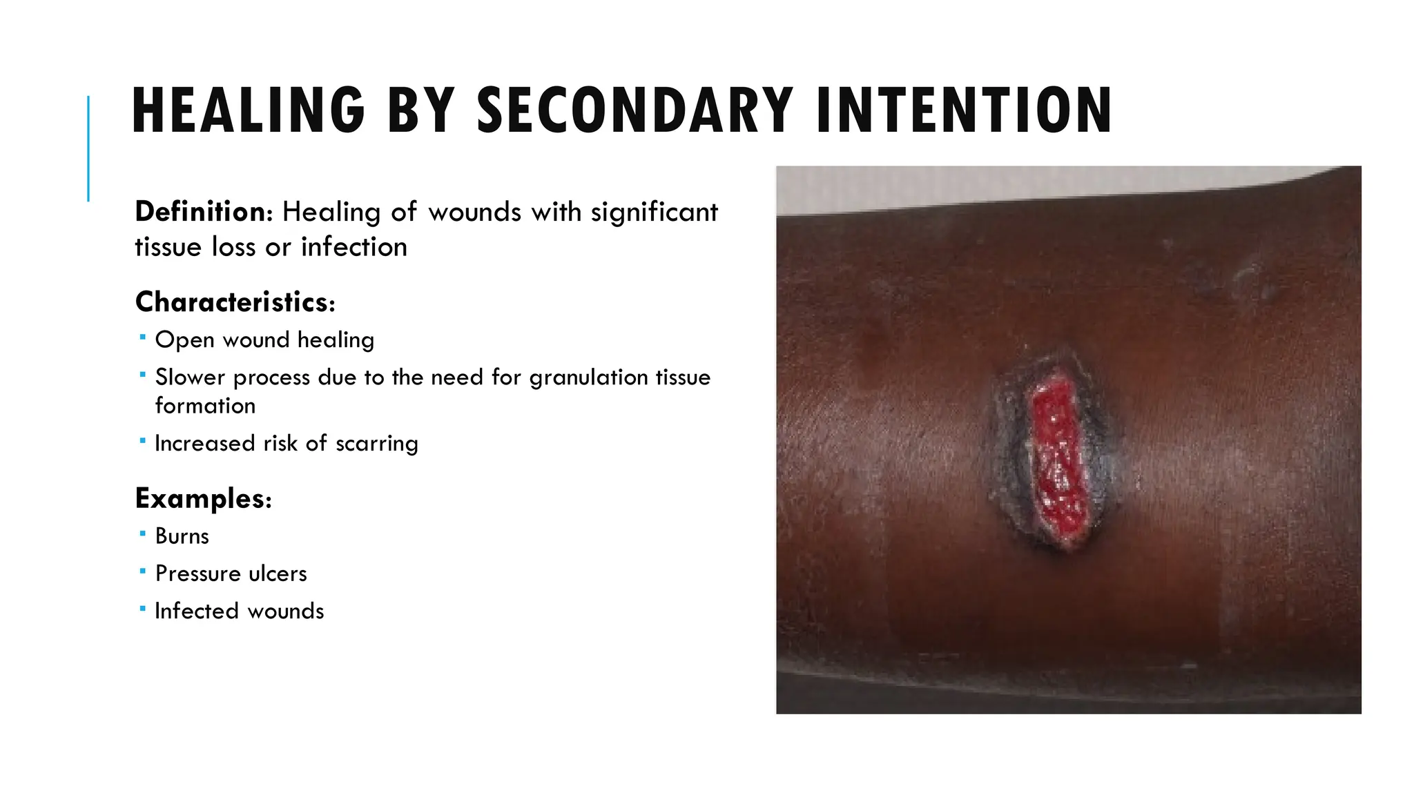 WOUND HEALING ,KELOIDS AND HYPERTROPHIC SCARS BY DR ABRAHAM.pptx