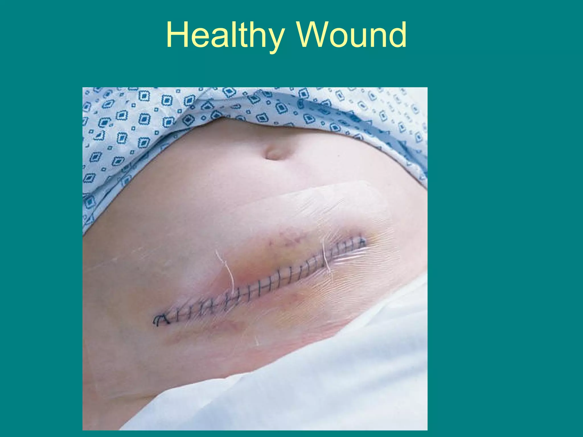 Wound healing Dr.Mahmoud Ameen | PPT
