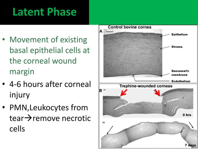 Wound healing of cornea | PPTX | Eye and Vision Conditions | Diseases ...