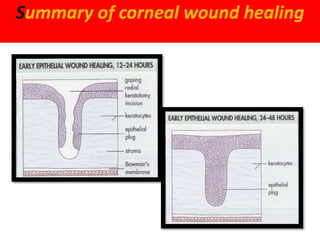 Wound healing of cornea | PPTX