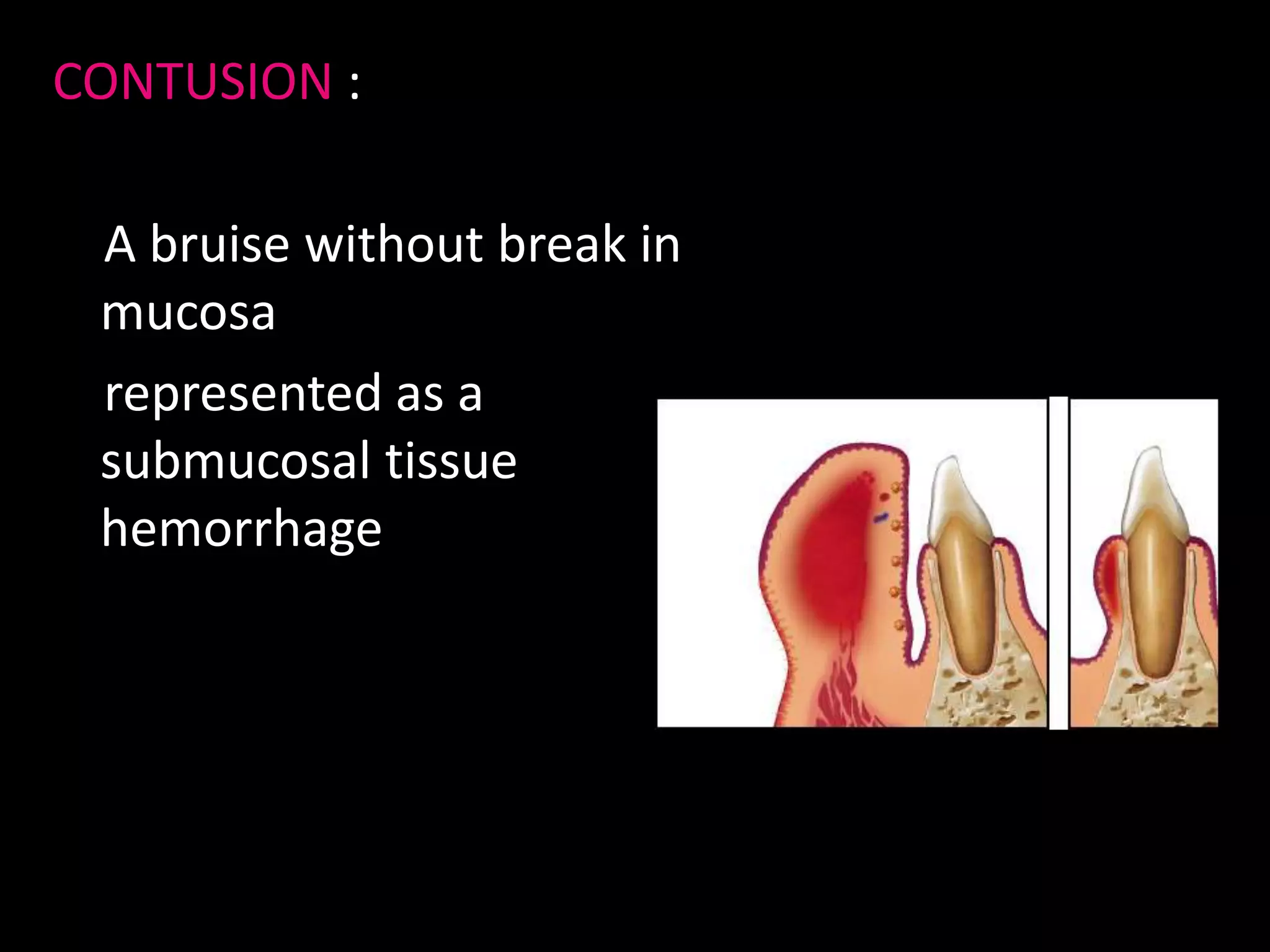 Wound healing of oral lesions | PPTX