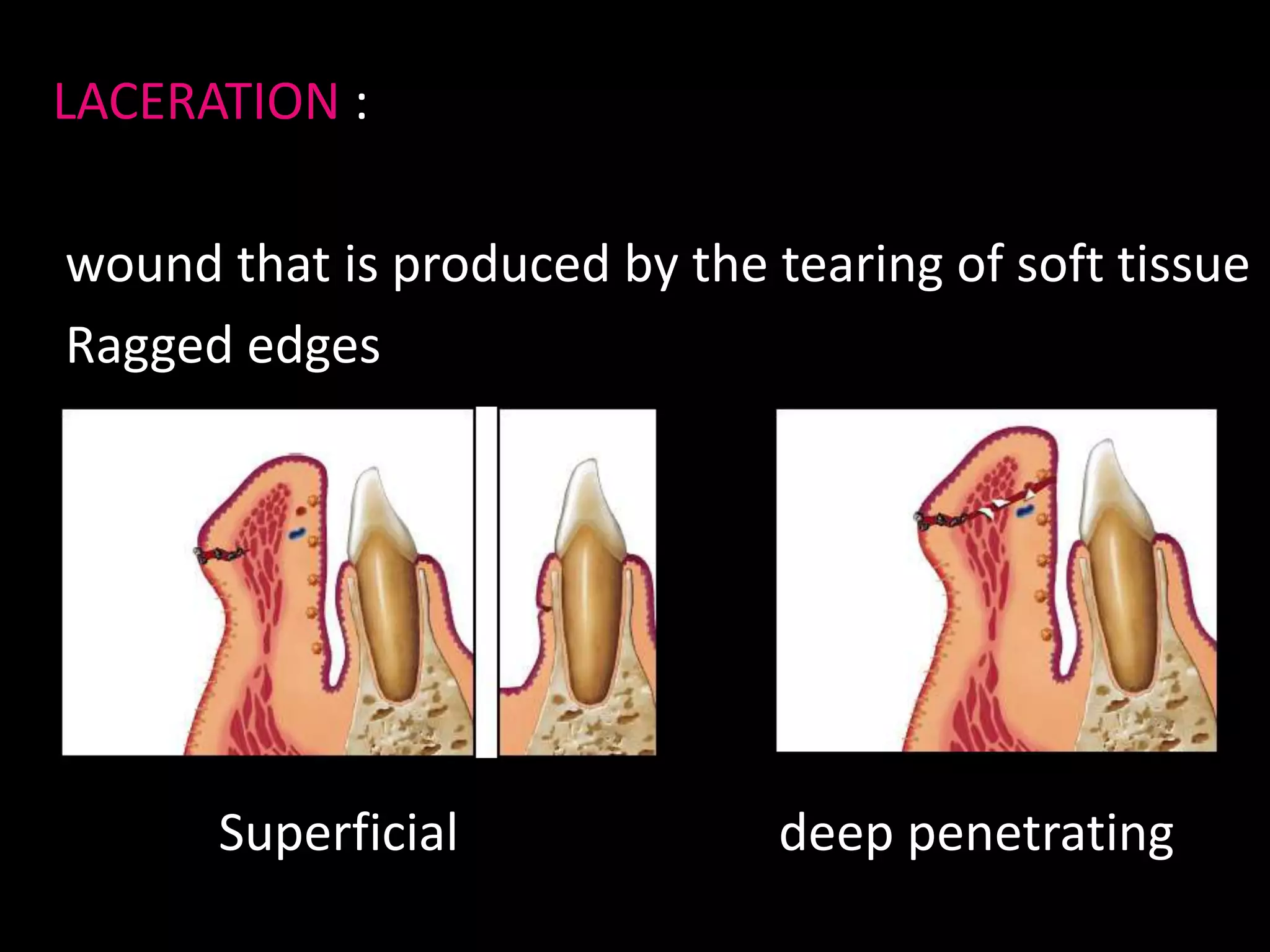 Wound healing of oral lesions | PPTX