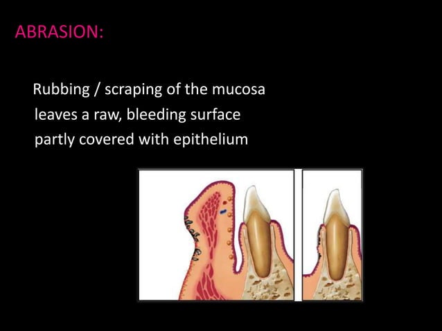 Wound healing of oral lesions | PPTX