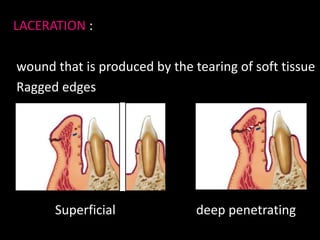 Wound healing of oral lesions | PPTX