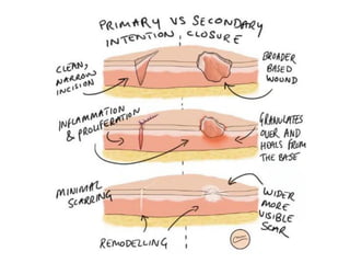 wound healing primary and secondary intention.pdf