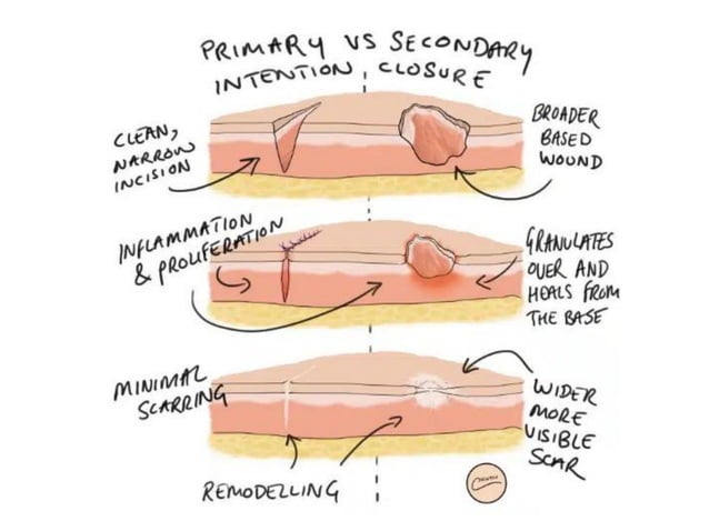 wound healing primary and secondary intention.pdf | Death, Injury, or ...