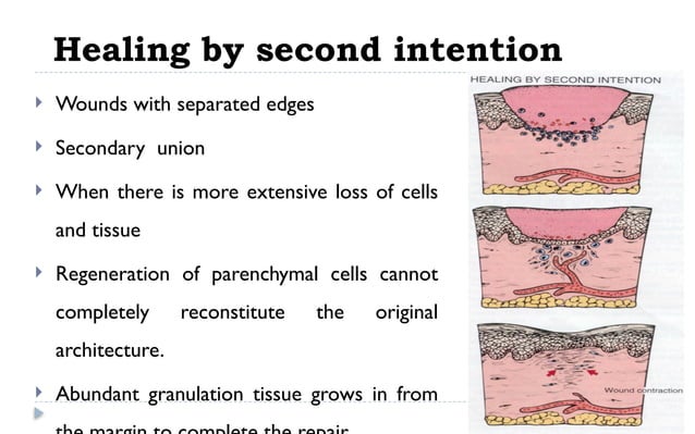 wound healing and types of wound healing and soft tissue and hardtissue ...