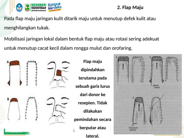 Wound Healing, Skin Graft, & Skin Flap dr. RI.pptx