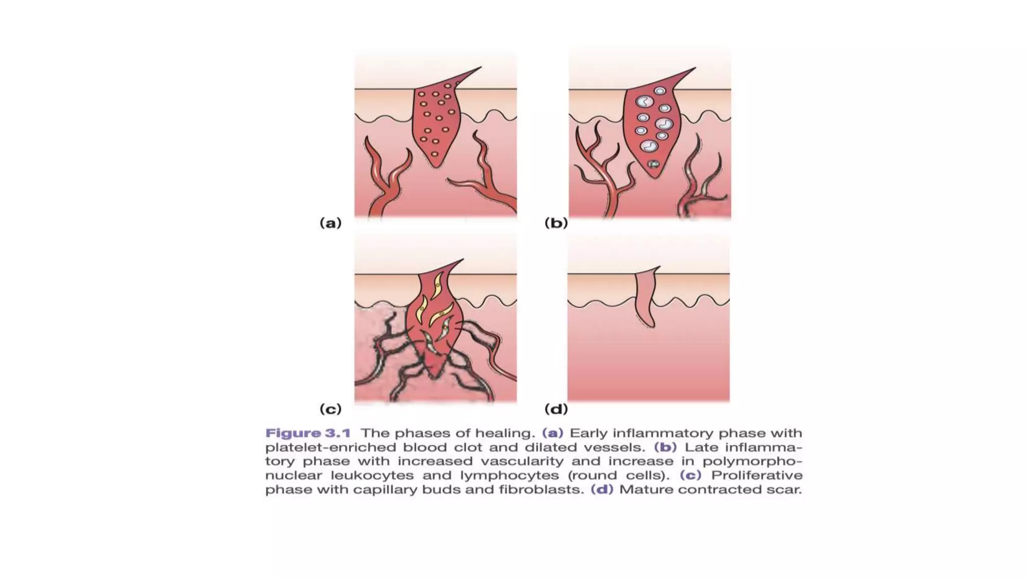 Wound infection | PPTX