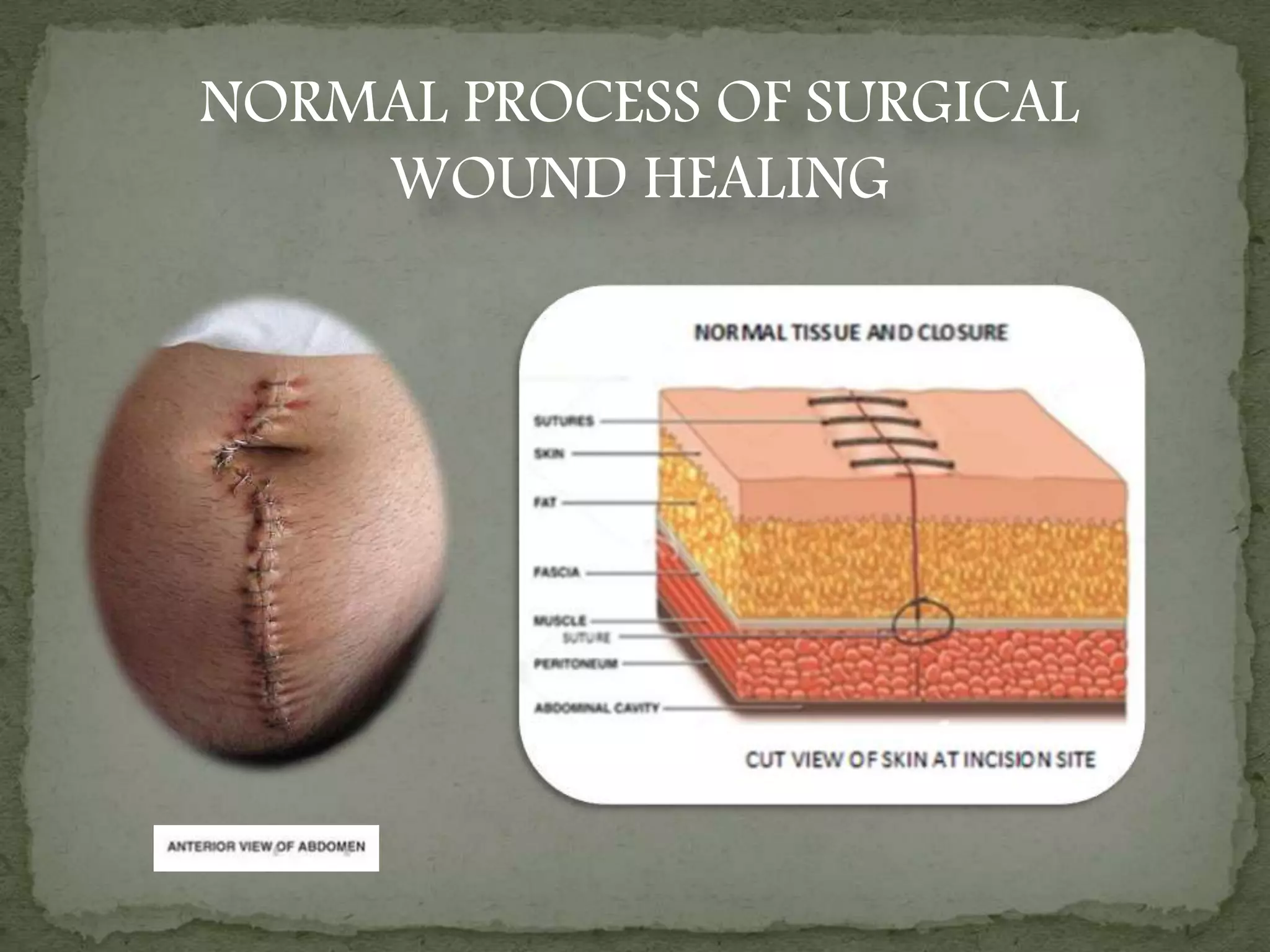 Wound infection (revised 27th feb 2017) | PPTX