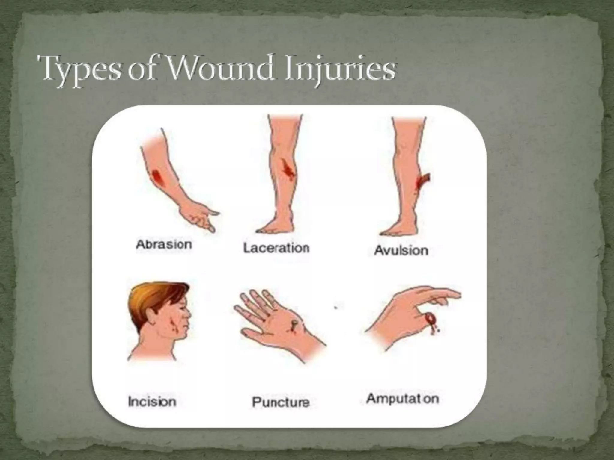 Wound infection (revised 27th feb 2017) | PPTX