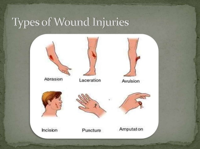 Wound infection (revised 27th feb 2017) | PPTX | First Aid | Injuries