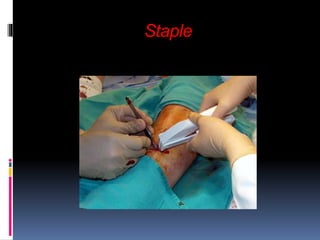 Wound Management | PPTX