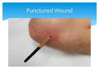 Wound management | PPTX