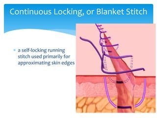 Running Locking Stitch