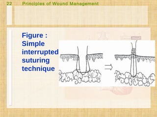 Wound management | PPT