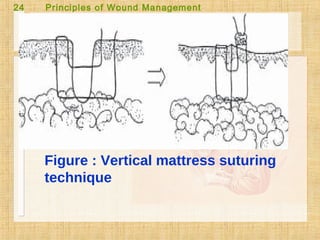 Wound management | PPT
