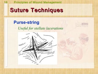 Wound management | PPT