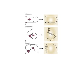 Wound management | PPTX