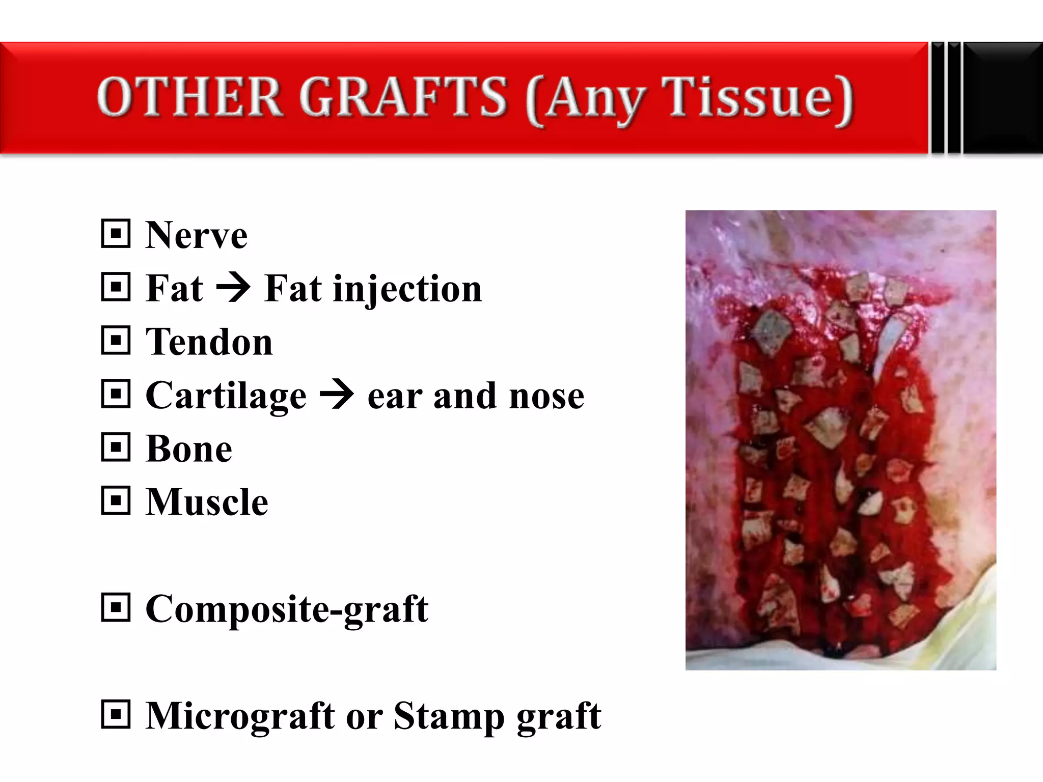 Wound Defect management | PPT