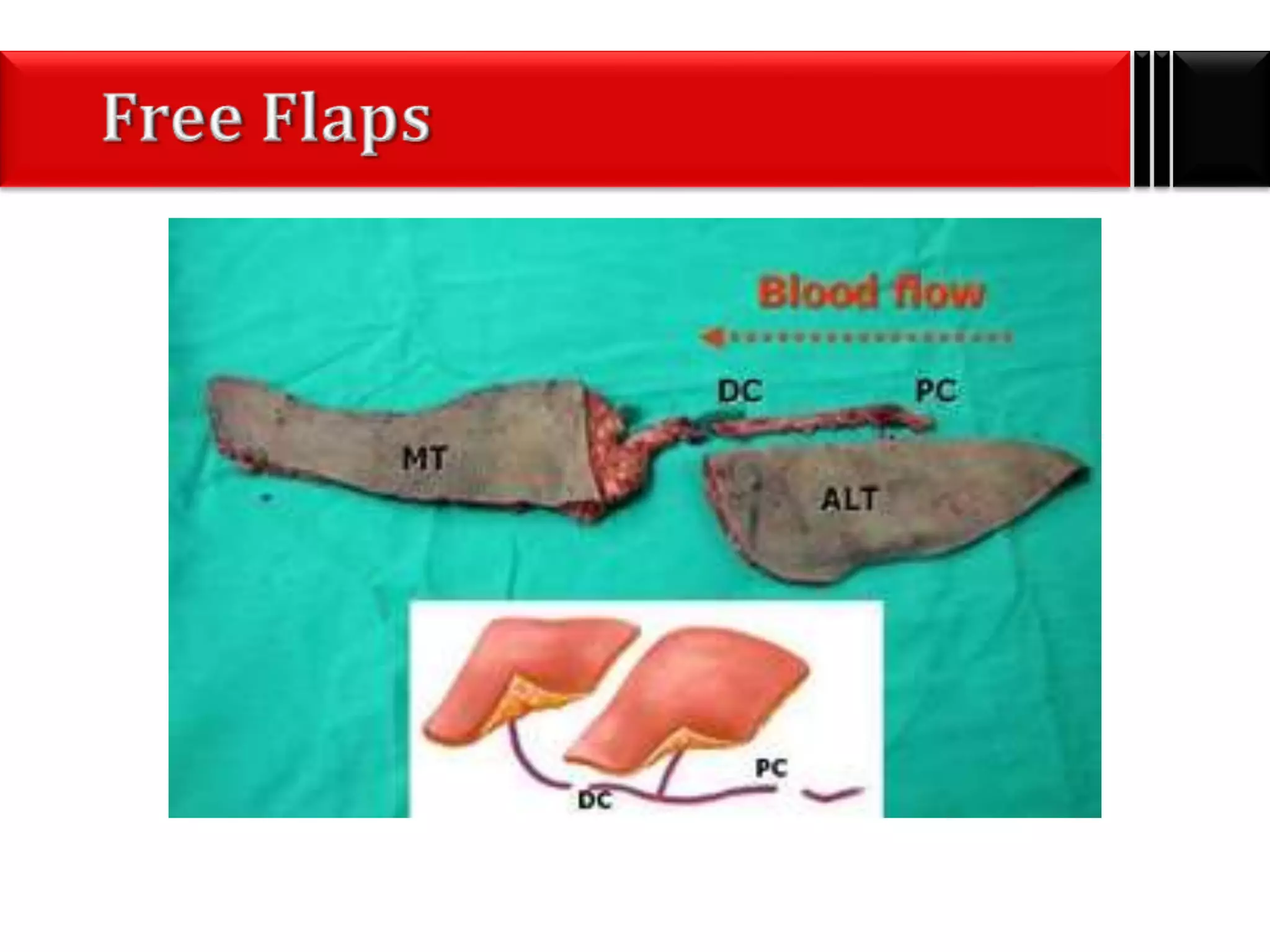 Wound Defect management | PPT