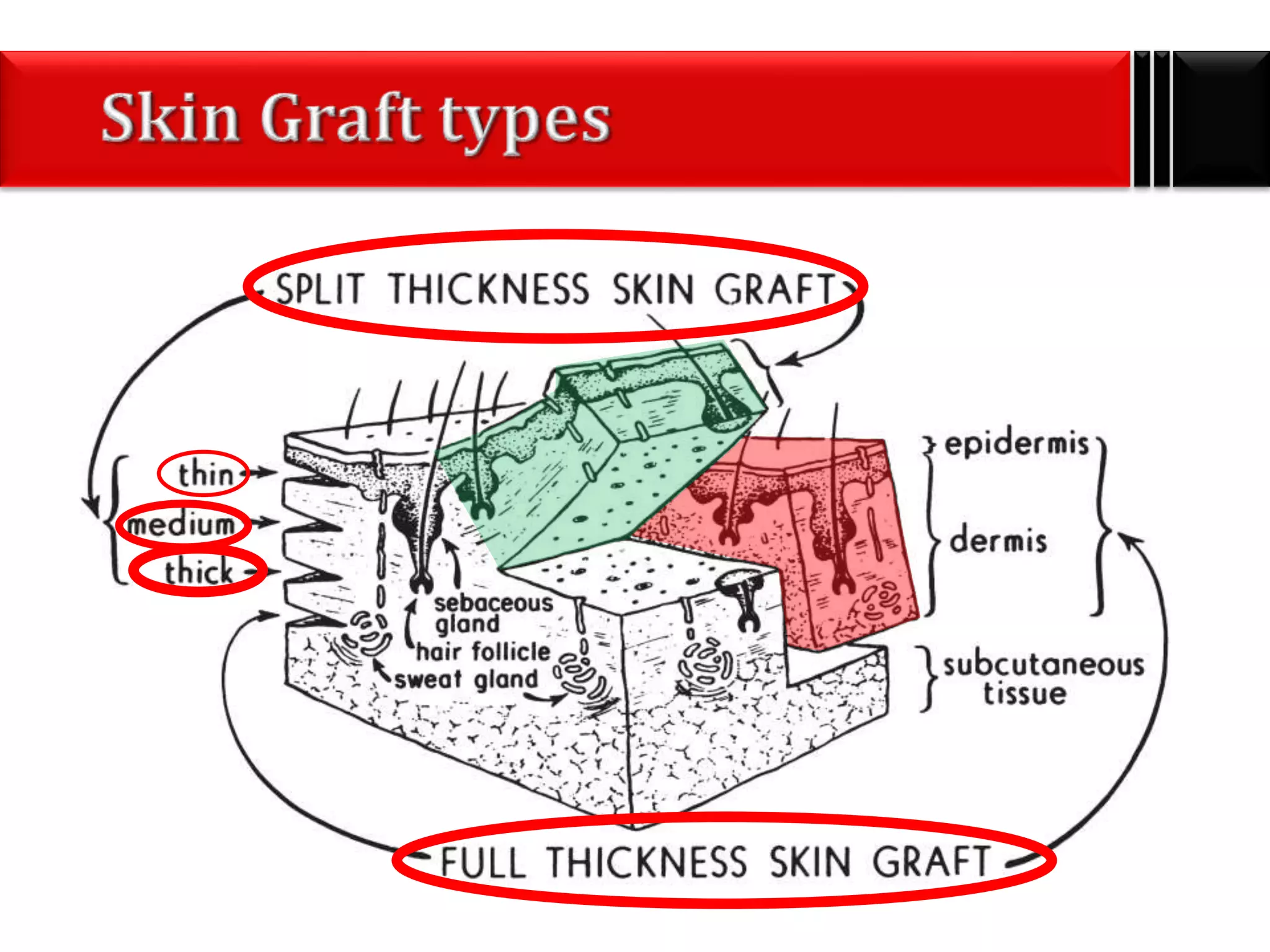 Wound Defect management | PPT
