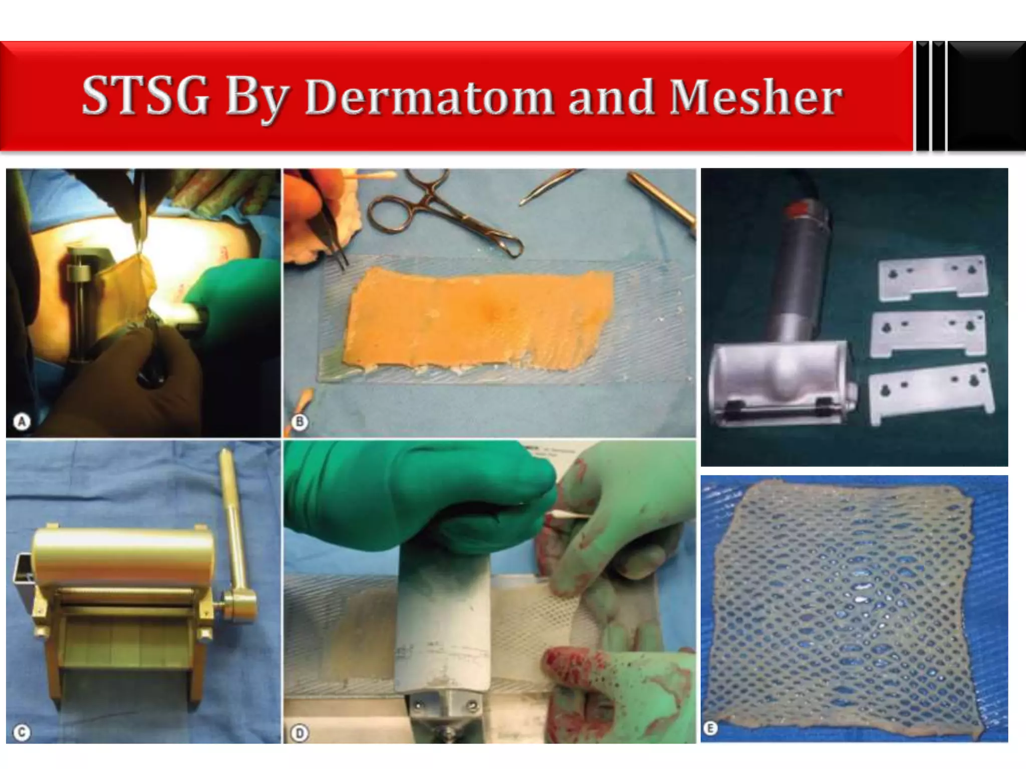 Wound Defect management | PPT