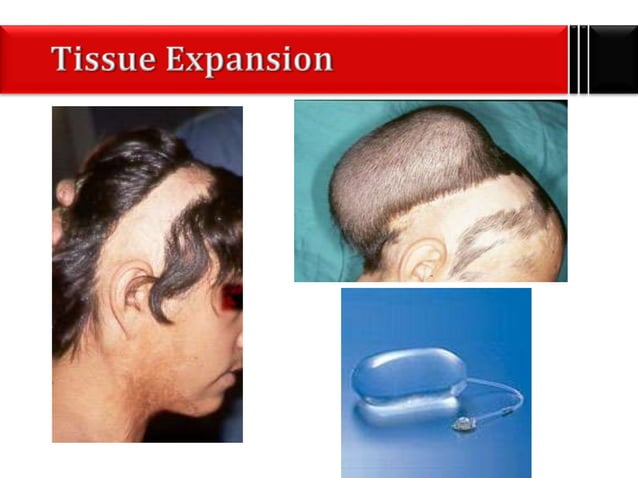 Wound Defect management | PPT