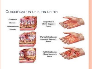 Wound management of burn | PPTX