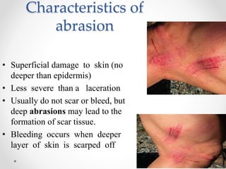 wound ppt.pptx, wound dressing , indication, types, procedure, | PPTX