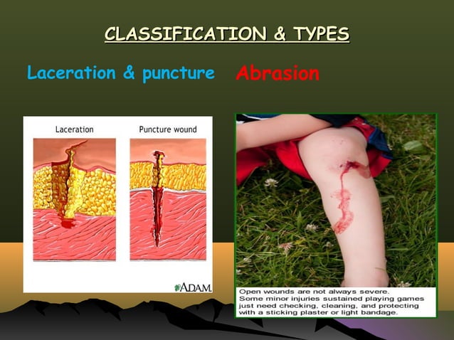 Wound ppt | PPT