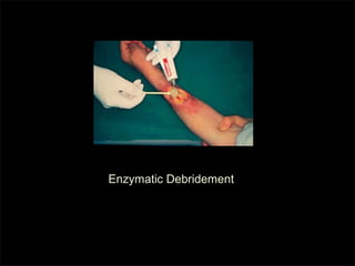 Wound products | PPT