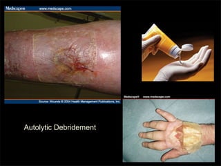 Wound products | PPT