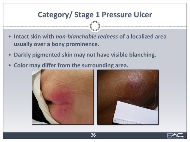 WoundRounds: Clinical Reimbursement and Wound Care webinar slides | PDF ...